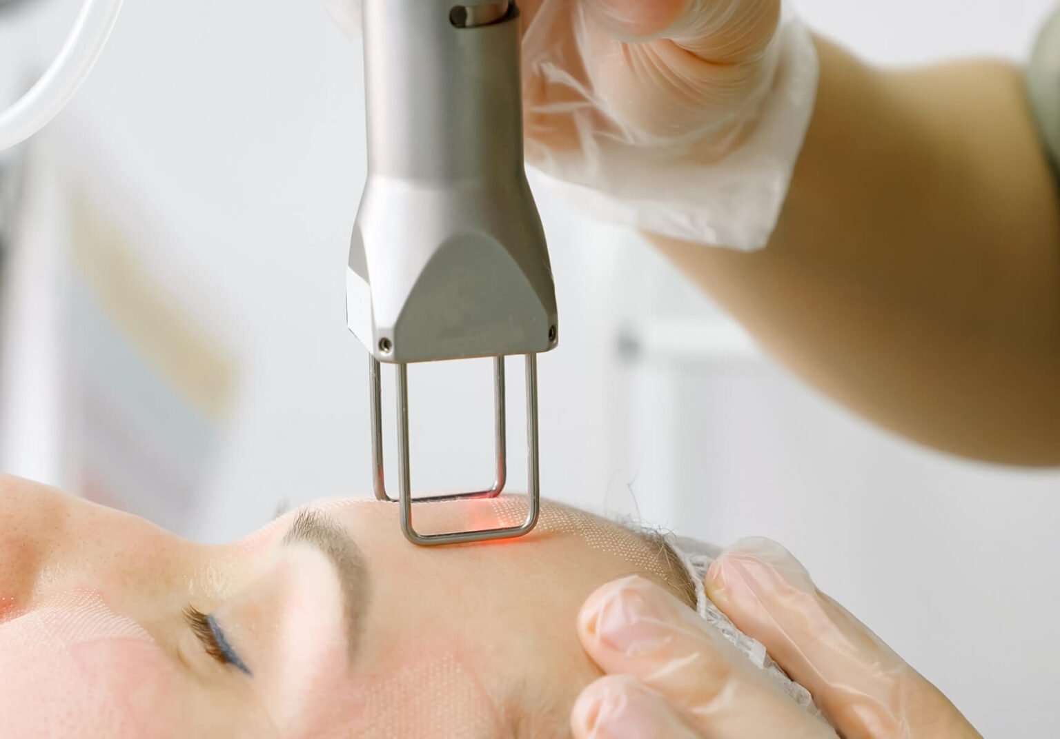 Tipos de depilación láser: ¿Cuál elegir?